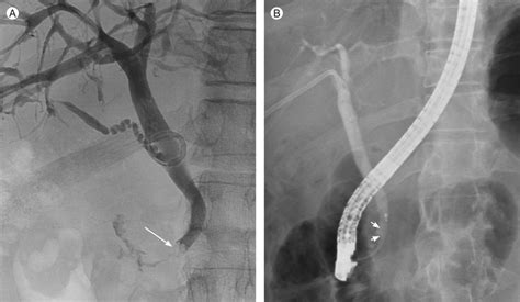 A Percutaneous Transhepatic Cholangiogram And B Endoscopic