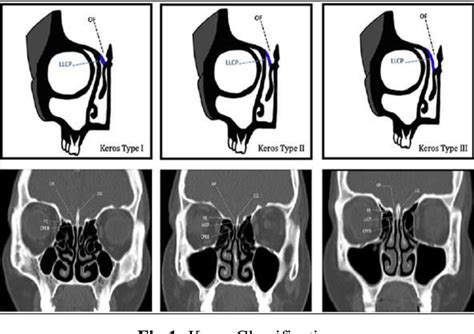 Figure 1 From Assessment Of Depth Of Olfactory Fossa In Pre Functional Endoscopic Sinus Surgery