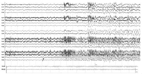 Electroencephalogram Eeg Nhs