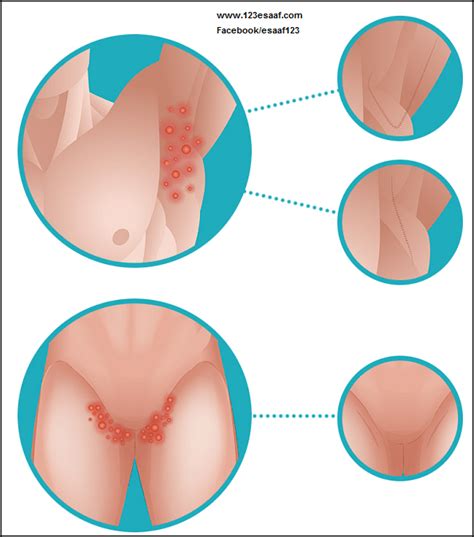 الالتهاب الجلدي التقيحي