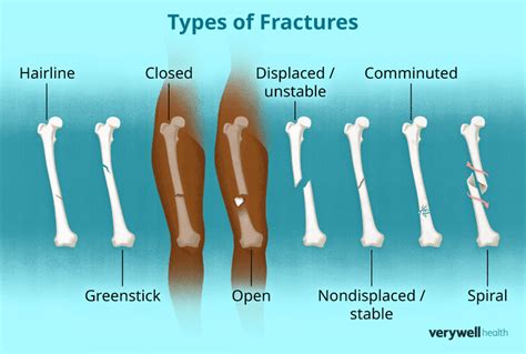 Fracture What It Means 8 Types Healing Process