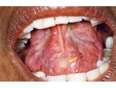 Lingual Frenulum Cancer