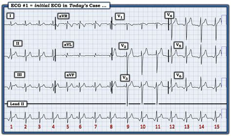 Ecg Interpretation Ecg Blog 510 — Myocarditis Or Acute Mi