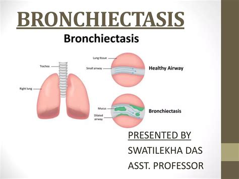 Bronchiectesis For Nurses Easy Explanation Pdf