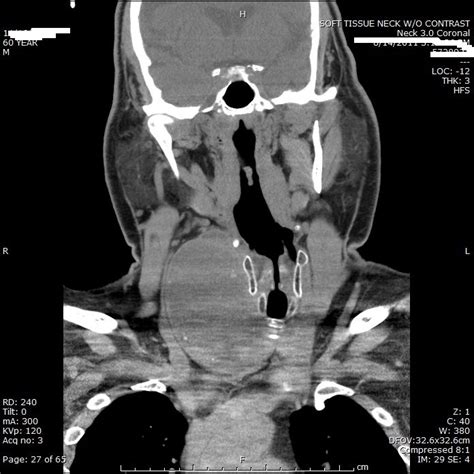 Thyroid Infection 4425 Thyroid Mass Surgery Photos
