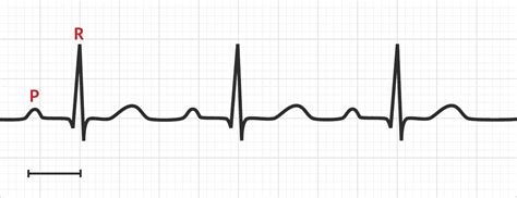 The PR Interval ECG Basics Medbabe
