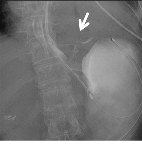 Figure 1 From A Case Of Spontaneous Esophageal Rupture To Thoracic