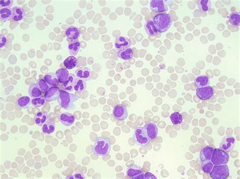 14 2 Chronic Myelogenous Leukemia Cml Medicine Libretexts