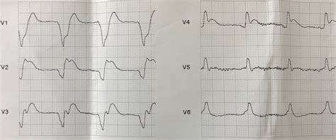 Anterior Mi In Paced Rhythm Dismissed By Cardiologist Patient Died