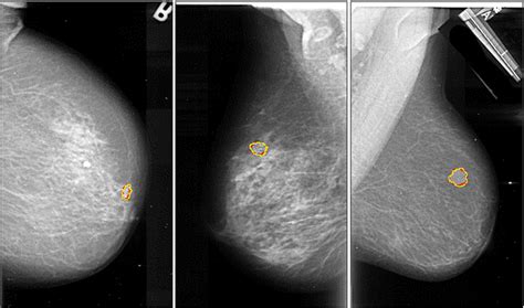 The Visual Assessment Of Breast Tumor Segmentation Using Our Download Scientific Diagram