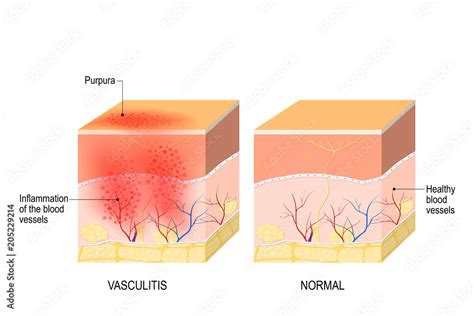 Vasculitis Cross Section Of The Human Skin With Vasculitis Stock