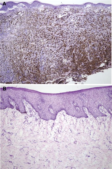 Oral Melanotic Macule And Primary Oral Malignant Melanoma Epidemiology