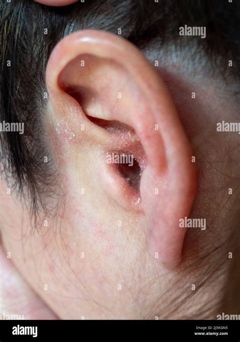 Red Dry Skin Behind Ear At David Trumper Blog