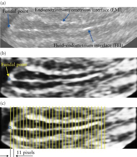 A New Method For Analysis Of Non‐pregnant Uterine Peristalsis Using