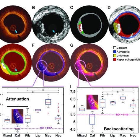 A Representative Example Showing The Calcified Plaque Detected In Oct