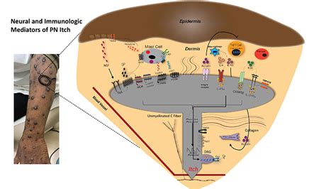 A New Era In Treating The Chronic Severe Itch Of Prurigo Nodularis Inventum