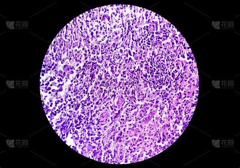 组织学染色片镜检图。恶性肿瘤幻灯片。活组织检查。特写镜头。涂片。癌症。