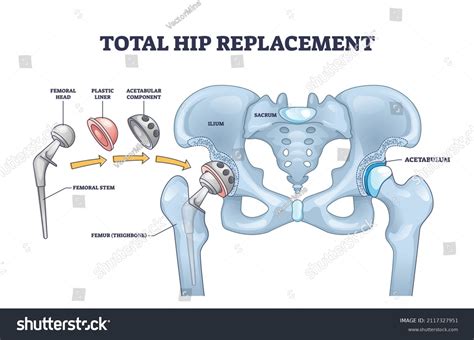Total Hip Replacement Surgery Anatomical Acetabular Stock Vector