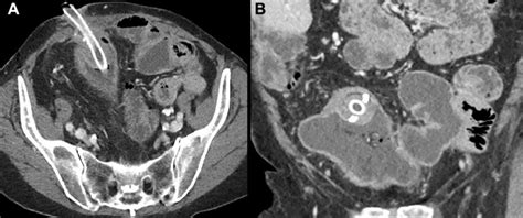 Normal Ct Enterography Appearance Of The Kock K Pouch A Axial Ct