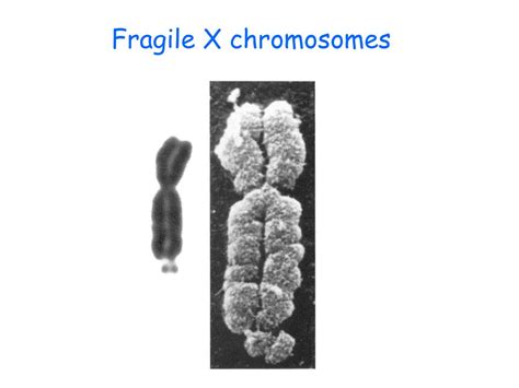 PPT Fragile X Syndrome PowerPoint Presentation Free Download ID 1138412