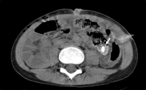 Left Sided Appendicitis Revealing A Common Mesentery A Case Report