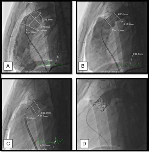 Hybrid Approach To Tpvr In The Native” Rvot Angiographic Measurements
