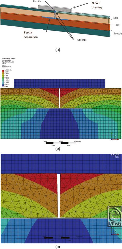 Three Dimensional Finite Element Analysis Computer Model Of Skin