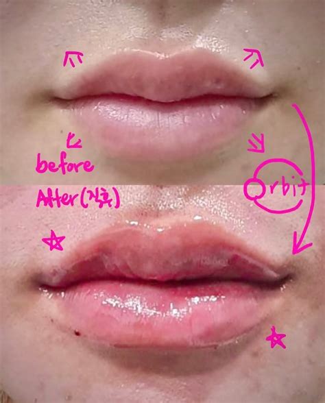 💋오빗의원 대표원장 심다현💋입술필러 전문 💋말린입술 볼륨 필러💋 궁금하신점은 댓글에 문의주세요😘 입술필러 입술필러후기 입술필러효과 입꼬리필러 입꼬리필러후기