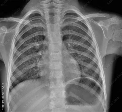 Normal Radiography Of Chest Organs In Direct Projection Pulmonology