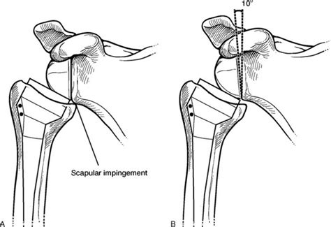 Glenoid Component Musculoskeletal Key