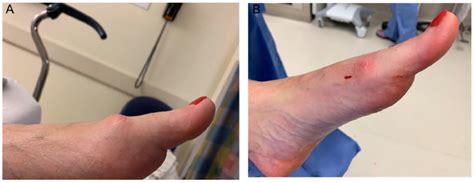 Modern Treatment Of Hallux Rigidus By Cheilectomy A Systematic Review Of Patient Reported