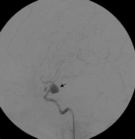 Cerebral Angiographic Image Lateral View Of The Left Internal Carotid