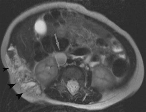Axial T2 Weighted Mr Image Depicts The Ivc Aneurysm Anteromedial To The