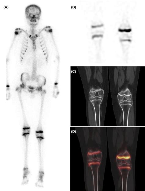 A Whole‐body Bone Scan Showing Intense Uniform Symmetric Tracer Download Scientific Diagram