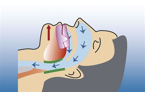 Mandibular Advancement Splints Intersleep Schweiz