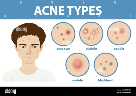 Acne Stock Vector Images Alamy
