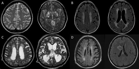 Examples Of The Brain Mri Findings Associated With Cryptococcus