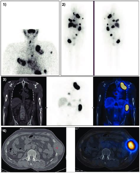99m Tc Pertechnetate Thyroid Scan Showing Small Residual Thyroid Download Scientific Diagram