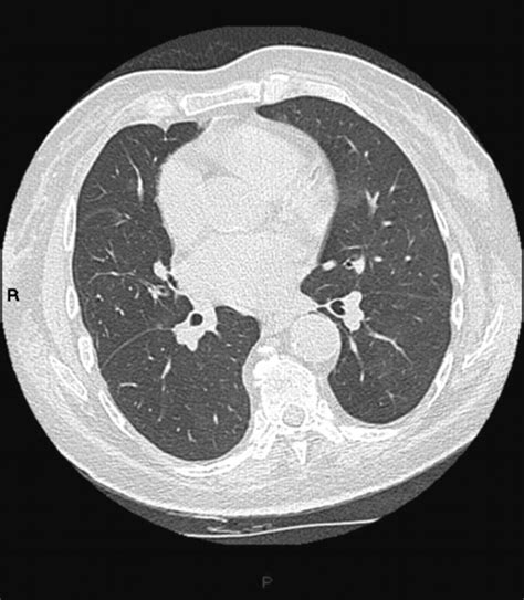 Multiple Pulmonary Nodules And If It Was Not A Cancer Thorax