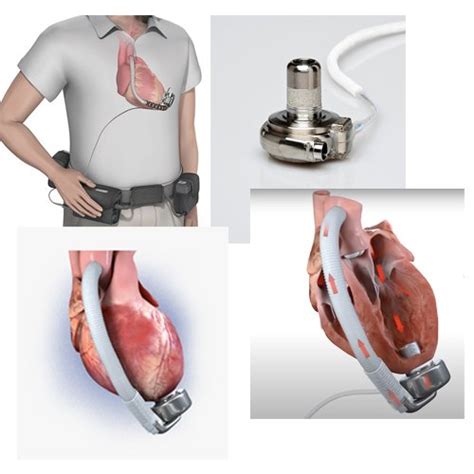 Ventricular Assist Devices Vaitya