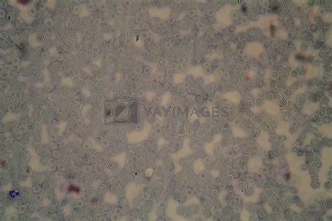 Malaria Parasites In Red Blood Cells Under The Microscope 400x By Dr