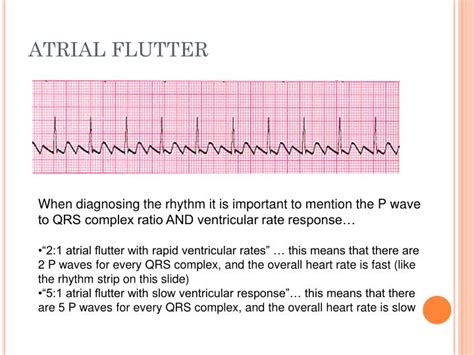 How To Calculate Atrial Rate In Atrial Flutter The Inducing Beats May Be Merely Benign