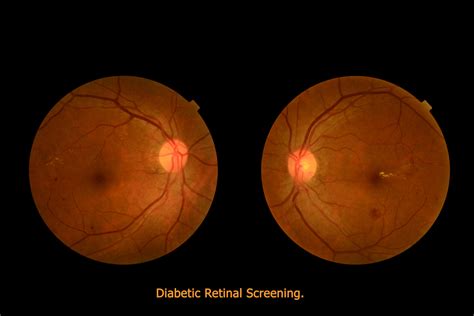 Diabetic Retinal Exam Eden Internal Medicine Eden Nc