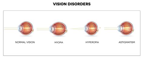 A Simple Guide To Refractive Error Global Vision 2020