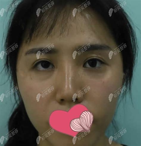 海南瑞韩整形不开刀祛眼袋1 7天的恢复图 这可是亲身经历哟 整容资讯 彩贝整容网