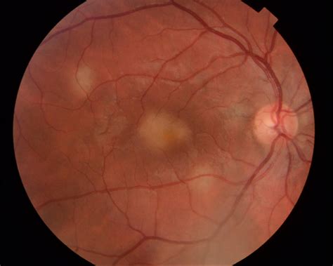 Evidence And Consensus Based Imaging Guidelines In Acute Posterior