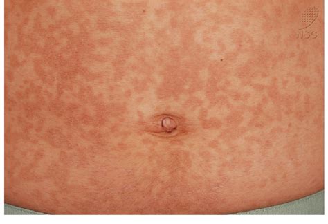 Confluent Reticulate Hyperpigmentation Over The Anterior Abdomen With