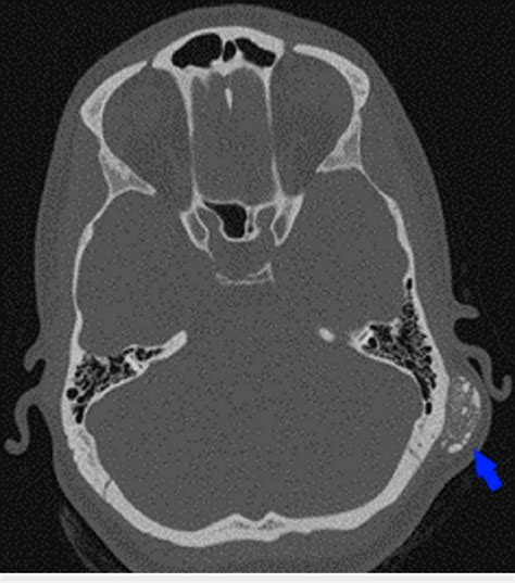 Temporal Bone CT Image Of The Lesion Blue Arrow Axial Section Download Scientific Diagram