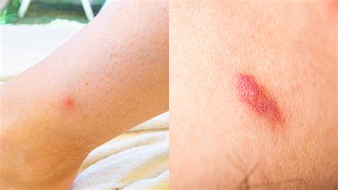 Guía Completa Sobre Picaduras De Chinches Identificación Tratamiento