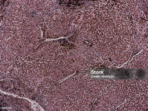 세포와 조직 현미경의 인간 병 리간 경 변 색소비정상적인 변경 0명에 대한 스톡 사진 및 기타 이미지 0명 간 내부 기관 간염 Istock